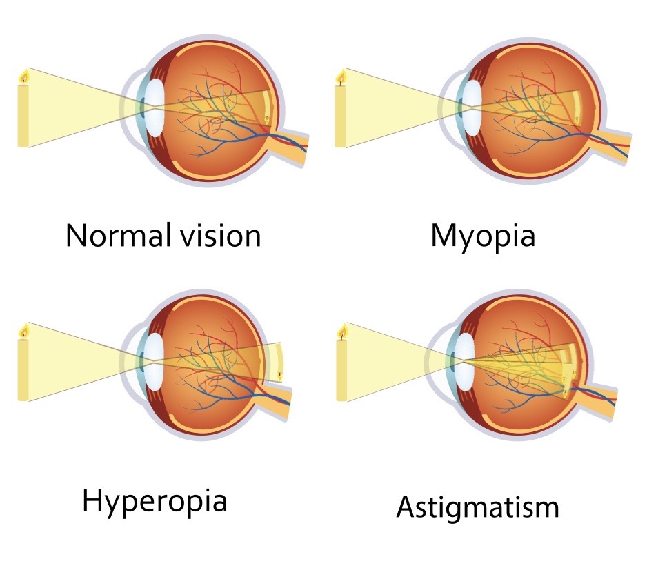 Astigmatism: Causes, Symptoms and Treatment | Eyesight Care Exercises